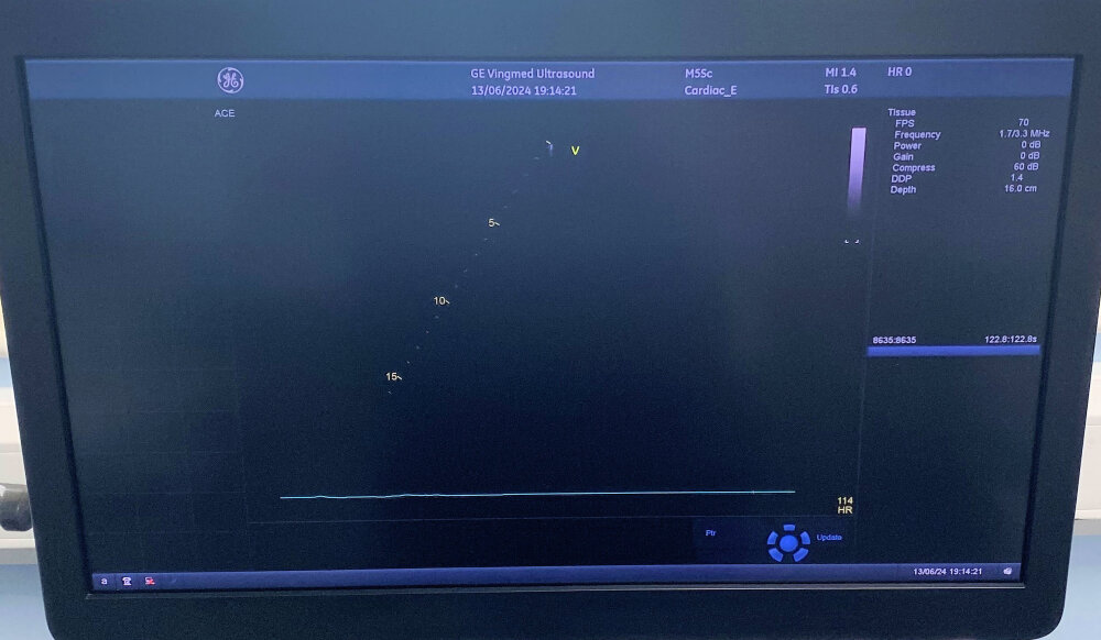 GE Vivid E95 Ultrasound System